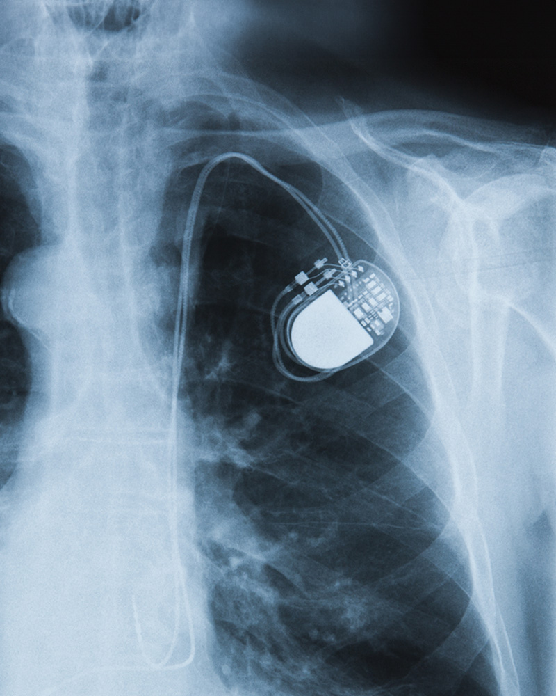 Pacemaker Placement | Cardiac Services | St Vincent's Private Hospitals