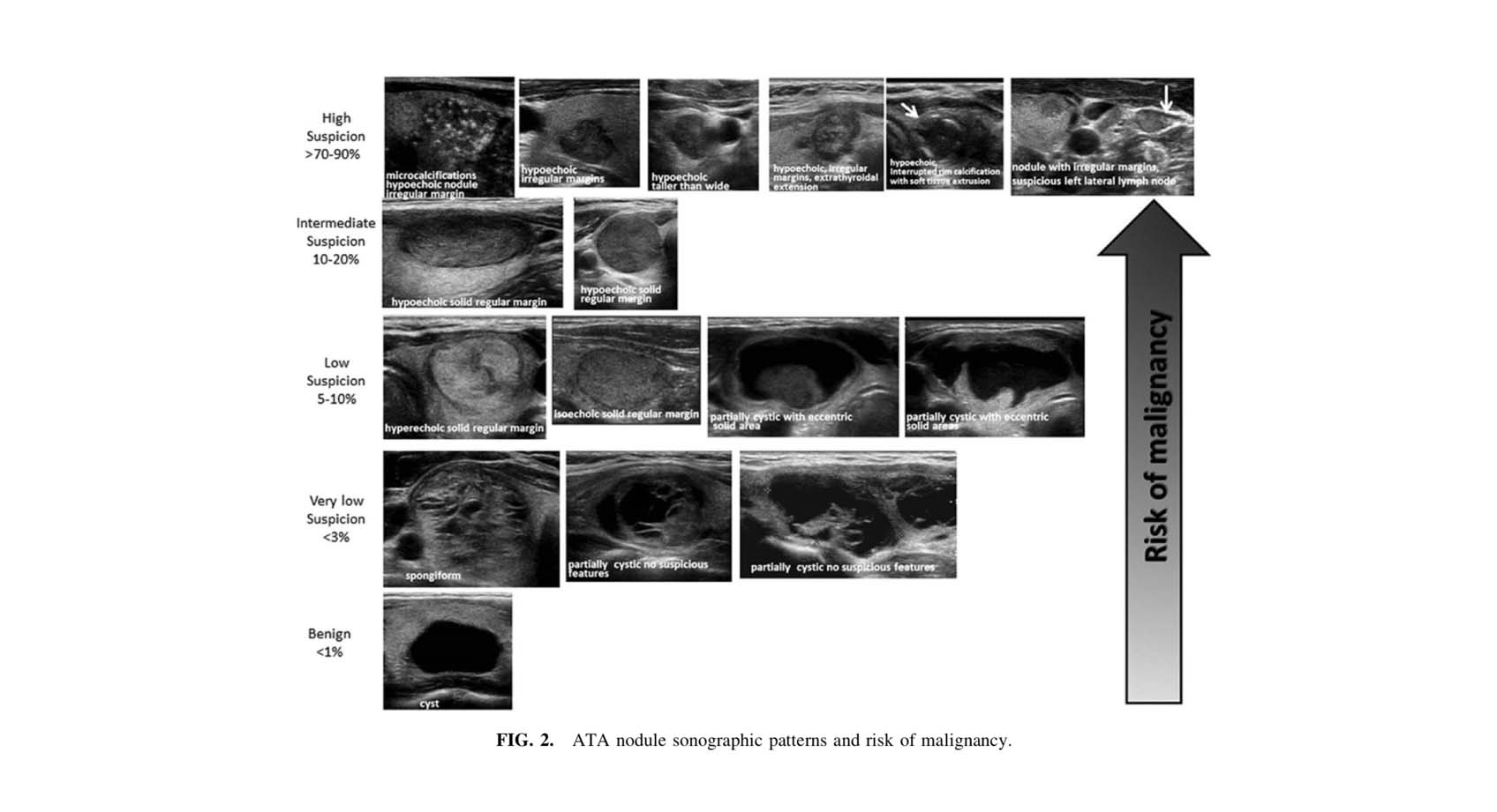 Thyroid Nodules | Mater Hospital Sydney