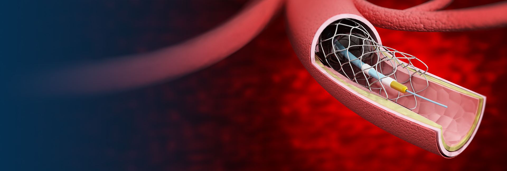 Coronary Angioplasty and Stents | Cardiac Services | St Vincent's ...