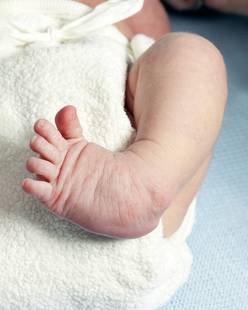 Clubfoot I Orthopaedics I St Vincent’s Private Hospitals