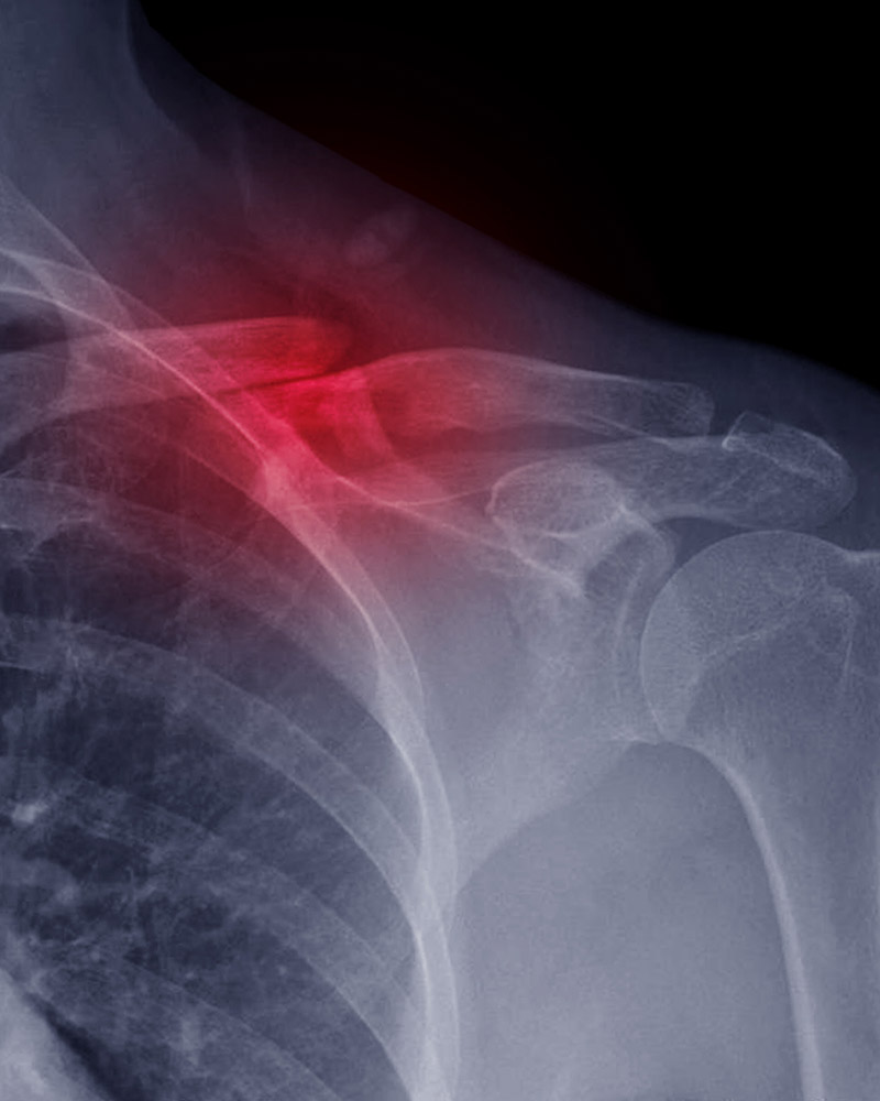 Shoulder Fracture I Orthopaedics I St Vincent’s Private Hospitals
