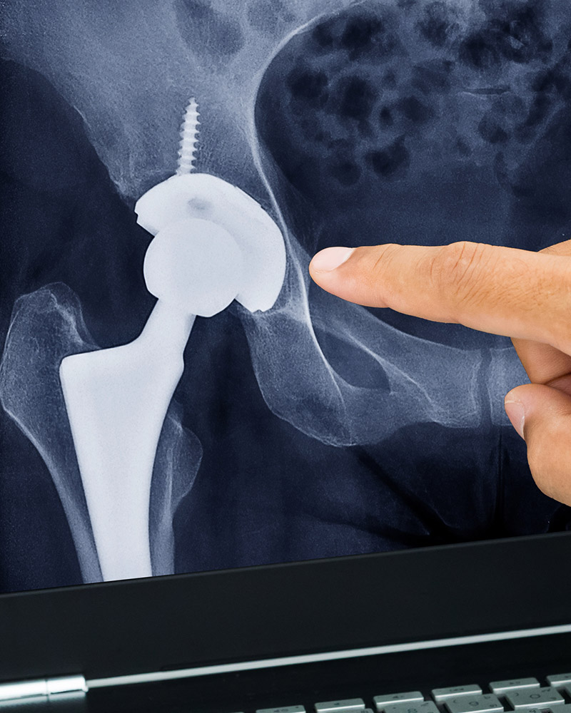 Hip Replacement Surgery in Brisbane I Orthopaedics I St Vincent’s ...