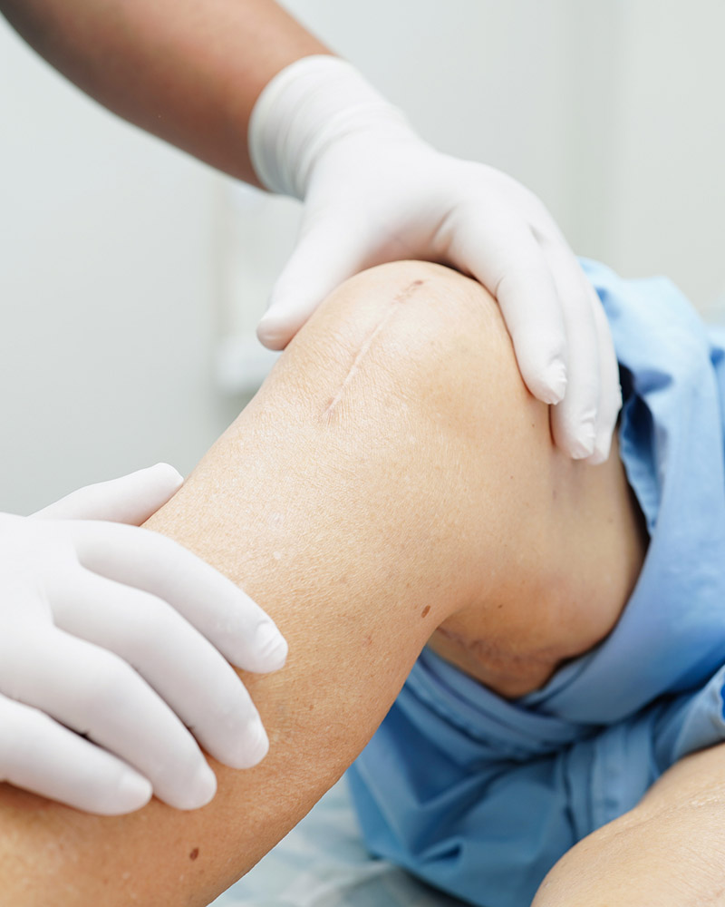 Knee Replacement Surgery in Melbourne I Orthopaedics I St Vincent’s ...