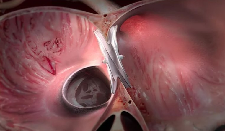 One quarter of the population live with a hole in the heart