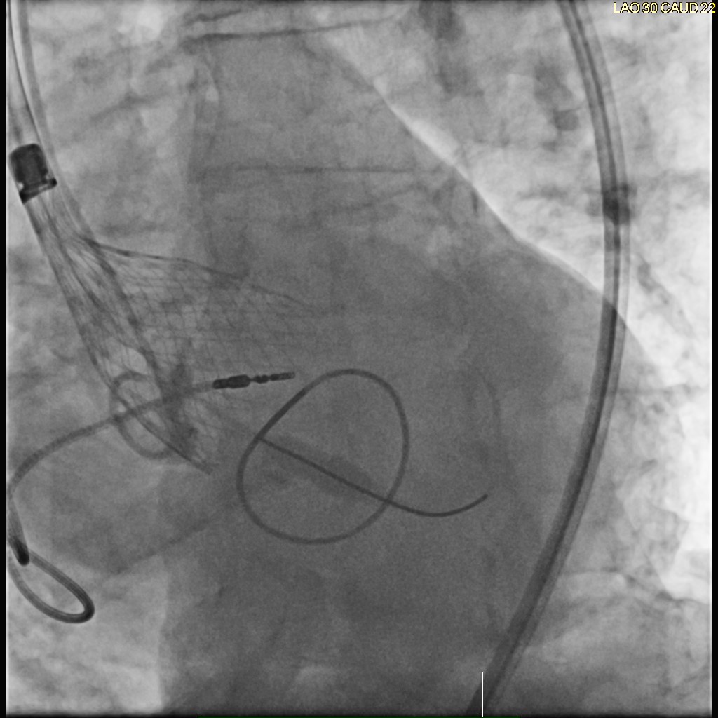 St Vincent’s team milestone 200th TAVI procedure gets patients back in ...